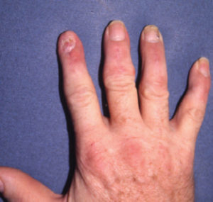 Microvascular Surgery - Miami Hand Center